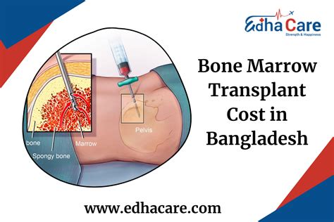 Bone Marrow Transplant Cost In Bangladesh Edhacare