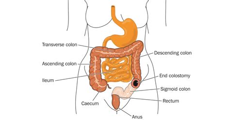 Loop Ileostomy Closure