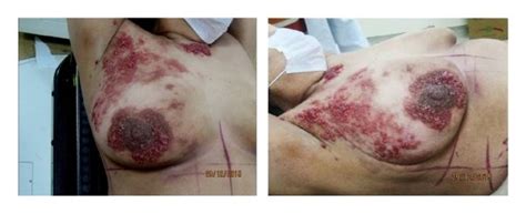 Multiple Subcutaneous Nodules On The Right Chest Wall Download