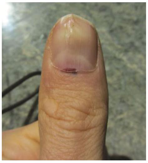 Subungual Melanoma