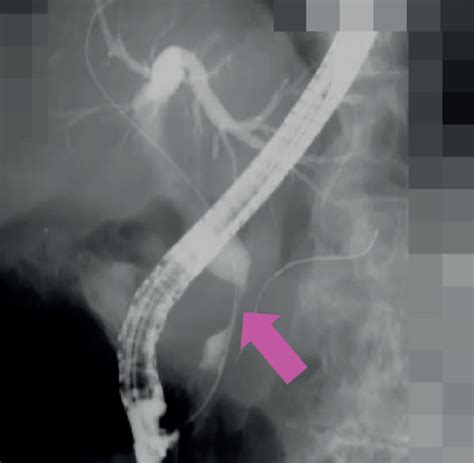 A Case Of Autoimmune Cholangitis A Cholangiography Shows The Biliary