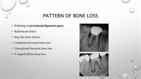 Vertical Root Fractures Pptx