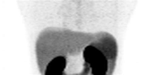 Gallium 68 Scan Pelvic Node Album On Imgur
