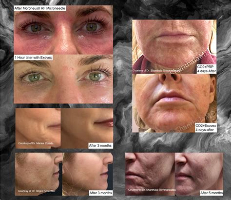 Exosome Facial In Prosper Tx Lotus Med Spa