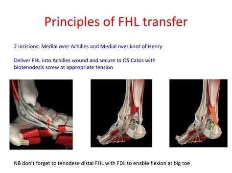 Ppt Peroneal And Achilles Tendon Problems With Surgical Management