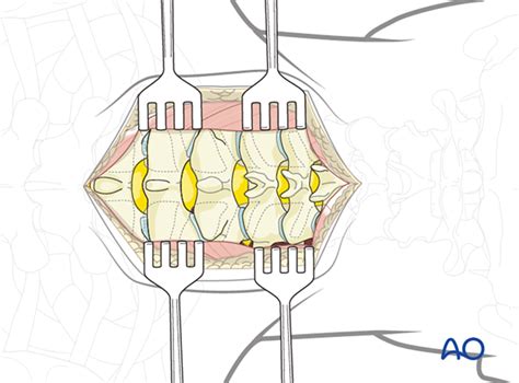 Posterior Access To The Cervicothoracic Junction C7 T2