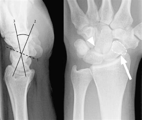 Lateral And Dorsi Palmar Dp Radiograph Of The Left Wrist Of A Patient