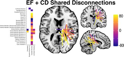 Common Patterns Of Network Level Disconnection Present In Both Patients