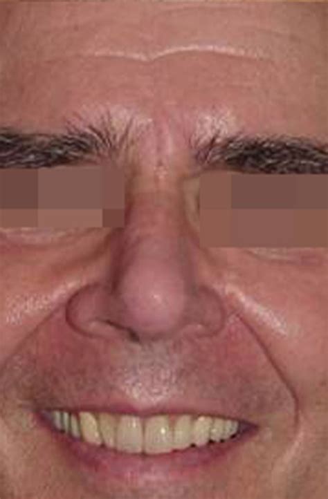 Nasal Reconstruction 17 Robert A Guida Md Pc