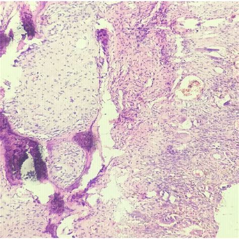 1a Radiograph Showing Osteolytic Lesion In Mid Diaphyseal Cortex Of Download Scientific