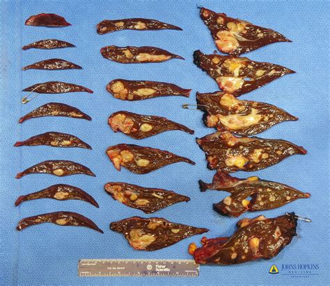 Metastatic Colorectal Adenocarcinoma Surgical Pathology Photo Website