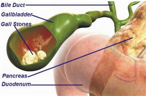 Gall Stones Vanguard News