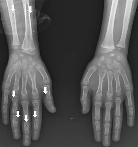 X Ray Of The Hands Reveals Bone Demineralization Of The Right Upper Download Scientific