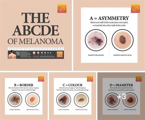 Malignant Melanoma Abcde Abcde Del Melanoma Hc Marbella