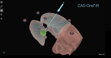 Cascination On Linkedin The March Top Case An Osteosarcoma Metastasis In A Previously Resected…
