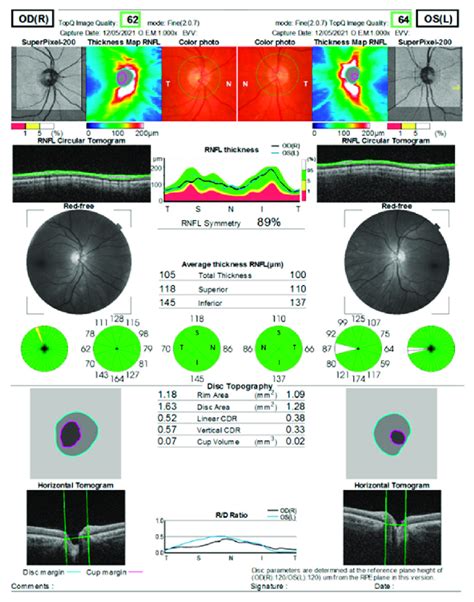 Visual Field And OCT Examination In Both Eyes Month After The Download Scientific Diagram