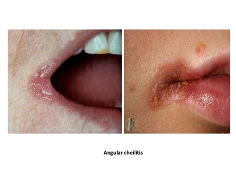 Cheilitis Cheilitis