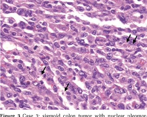 Histiocytic Sarcoma Semantic Scholar