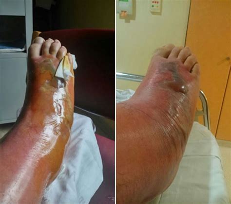 Brown Recluse Spider Bite First Few Days