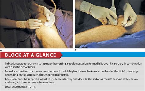 Ultrasound Guided Saphenous Nerve Block Anesthesia Key