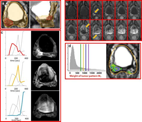 Axial And Sagittal View Of Prostate Bed On T2 Weighted Mri Of A Patient Download Scientific