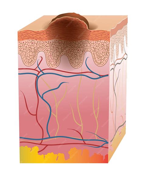 Иллюстрация поперечного сечения рака кожи Премиум векторы