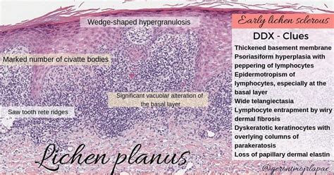 Lichen Planus Histology
