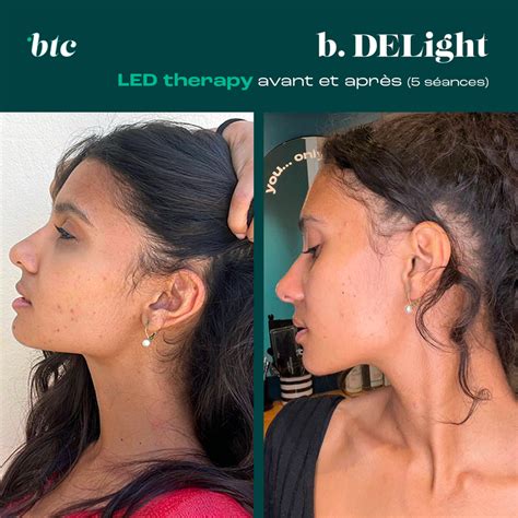 Photobiomodulationled Therapy Better Than Cream