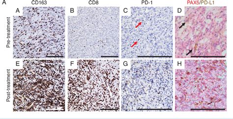 Figure 3 From Activity Of Pd 1 Blockade With Nivolumab Among Patients With Recurrent Atypical