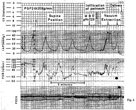 Figure 4 From Intravenous Prostaglandin F2α And Amniotomy For The Elective Induction Of Labor At