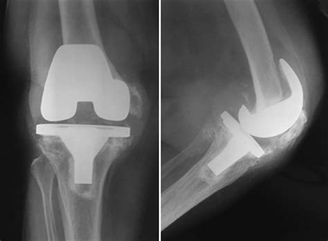 Right Knee With Total Knee Prosthesis In Situ Showing Collapse Of