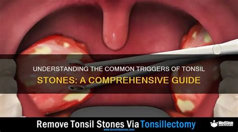 Understanding The Common Triggers Of Tonsil Stones A Comprehensive Guide Medshun