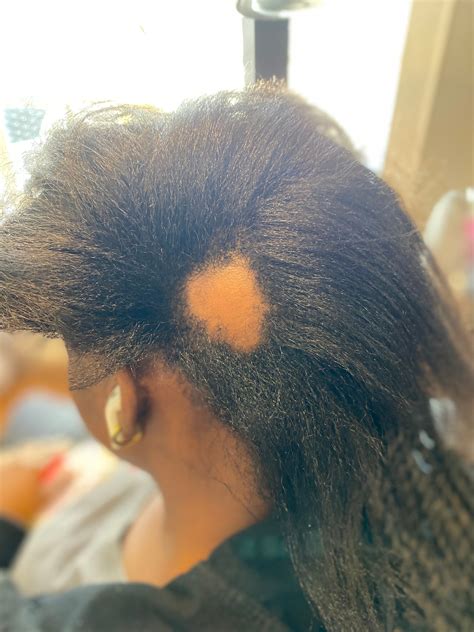 Scalp Evaluation Trichoscopy Houston Trichology