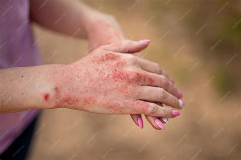 Premium Photo Close Up Dermatitis On Skin Ill Allergic Rash Eczema