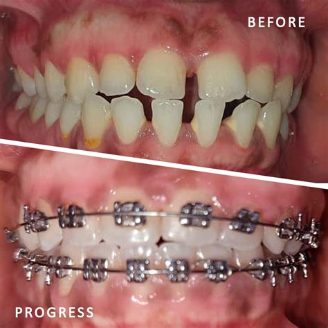 Dental Braces Type Process Maintenance Tips Prices Hilton