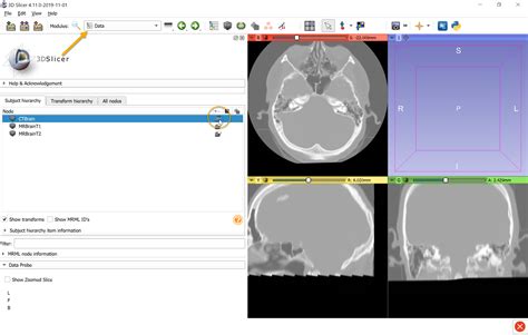 Overview 3d Slicer Segmentation Recipes