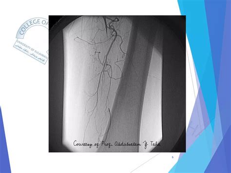Superficial Femoral Artery Occlusionpdf