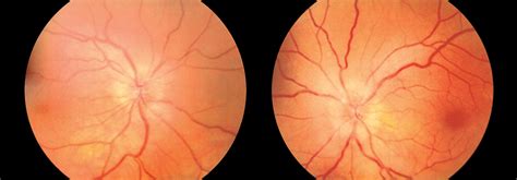 Bilateral Simultaneous Anterior Ischemic Optic Neuropathy In A Young