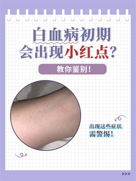 白血病初期会出现小红点教你鉴别 家庭医生在线家庭医生在线首页频道