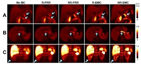 Motion Correction Enables Quantitative PET Scans Physics World