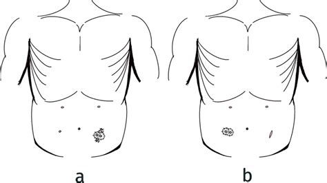 The Site Of Temporary Ileostomy A Sses B Sns Sses Stoma Through The Download Scientific The Site Of Temporary Ileostomy A Sses B Sns Sses Stoma Through The Download Scientific
