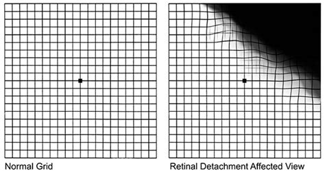 Retinal Detachment Surgery Retina Doctors In New York