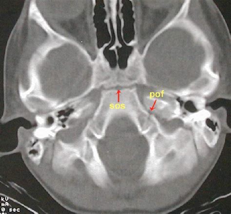 Spheno Occipital Suture