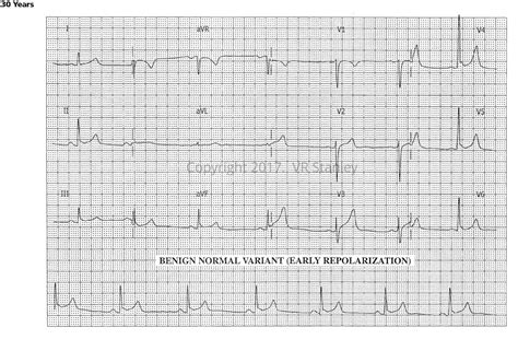 Terminal Qrs Distortion On The 12 Lead Ecg