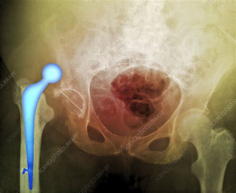 Dislocated Hip Prosthesis X Ray Stock Image C0032979 Science