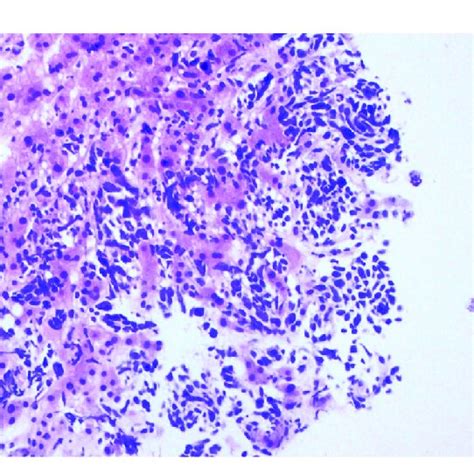 Biopsy Pathology Of Liver Mass Small Cell Cancer He ×200