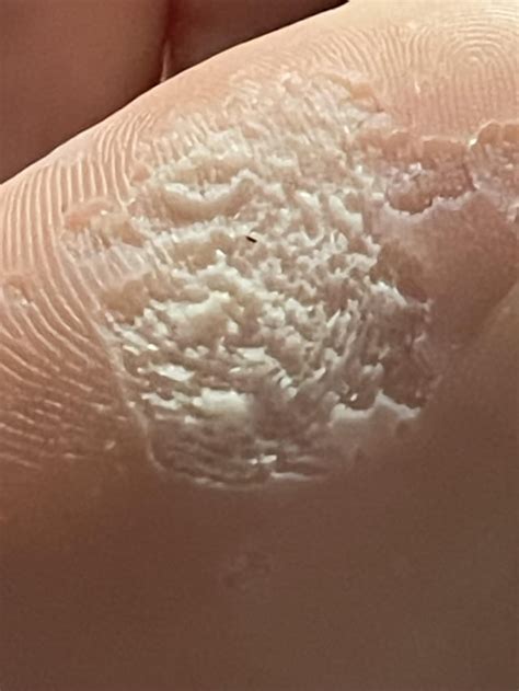What Is This On My Foot Rdermatologyquestions