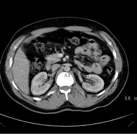 Axial Perfusion Ct Image Shows Rois Around The Renal Cortex And Medulla Download Scientific