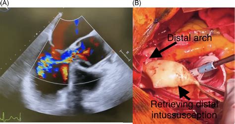 A Transesophageal Echocardiogram Proximal Intussusception Of The Download Scientific Diagram