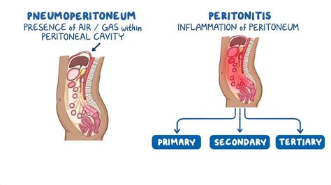 Peritonitis